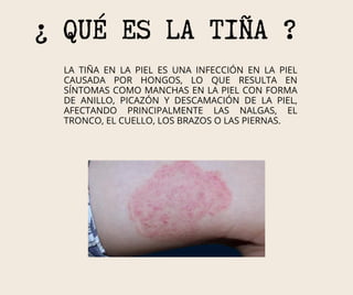la tiña hongos en el tejido tegumentario | PDF