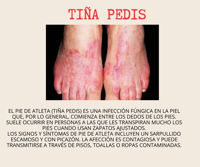 la tiña hongos en el tejido tegumentario | PPT