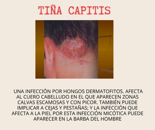 la tiña hongos en el tejido tegumentario | PDF