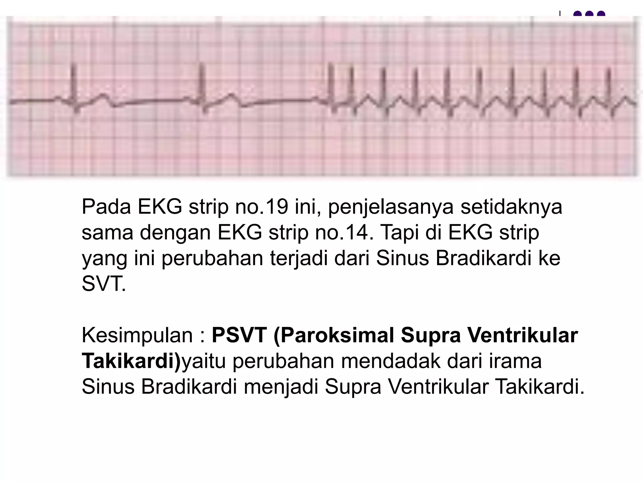 Latihan EKG Strip | PDF