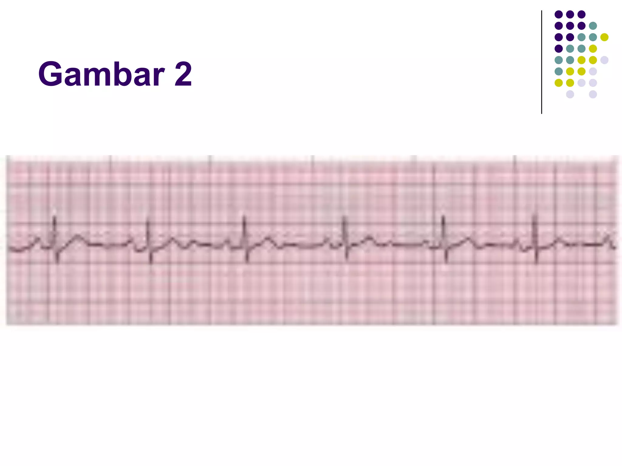 Latihan EKG Strip | PDF
