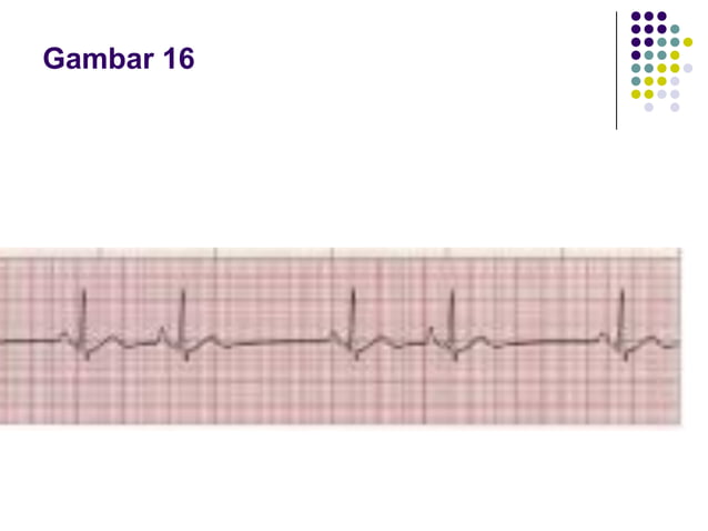 Latihan EKG Strip | PDF