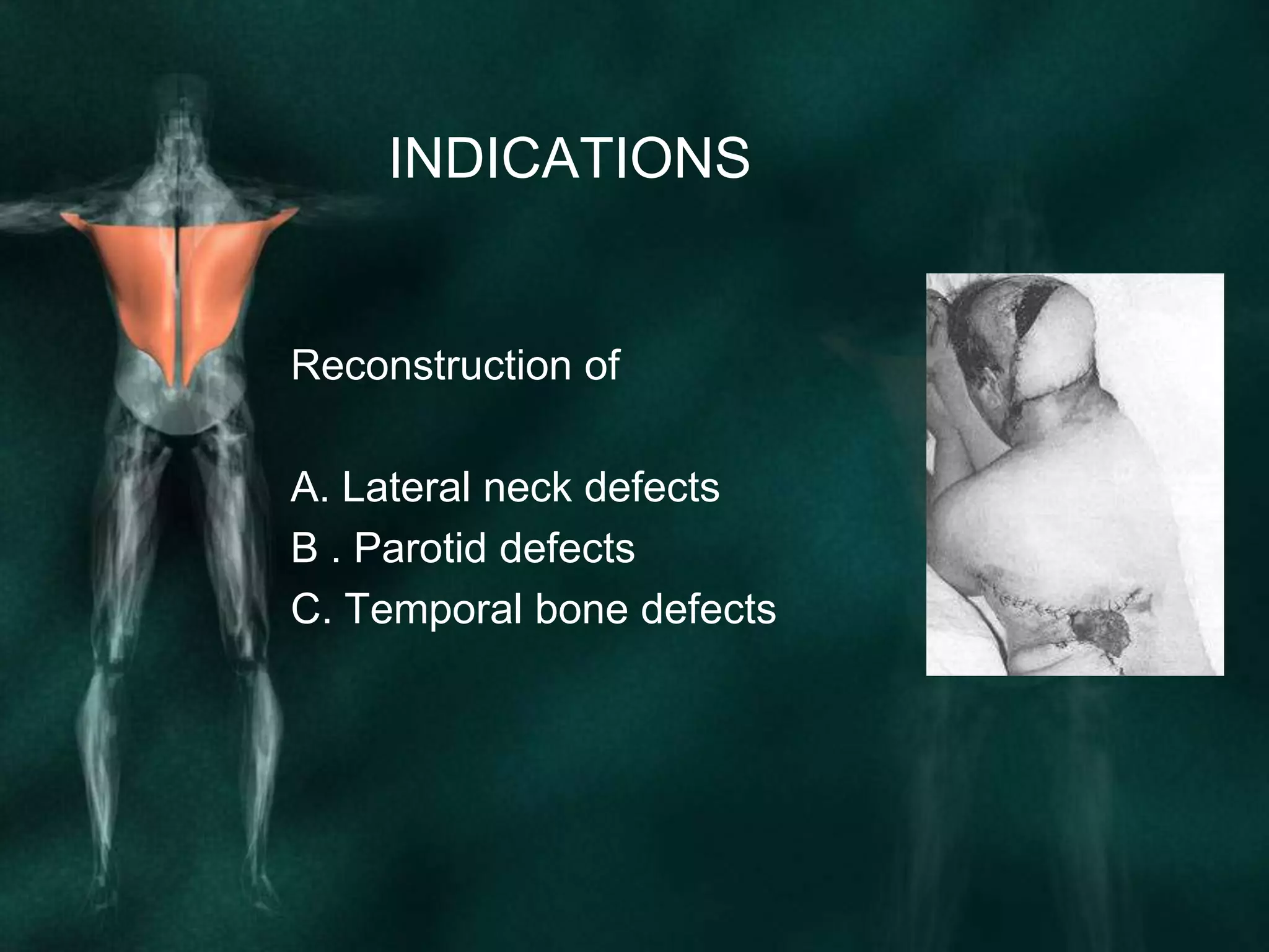Latissimus dorsi flap for reconstruction in head and neck deffects | PPTX