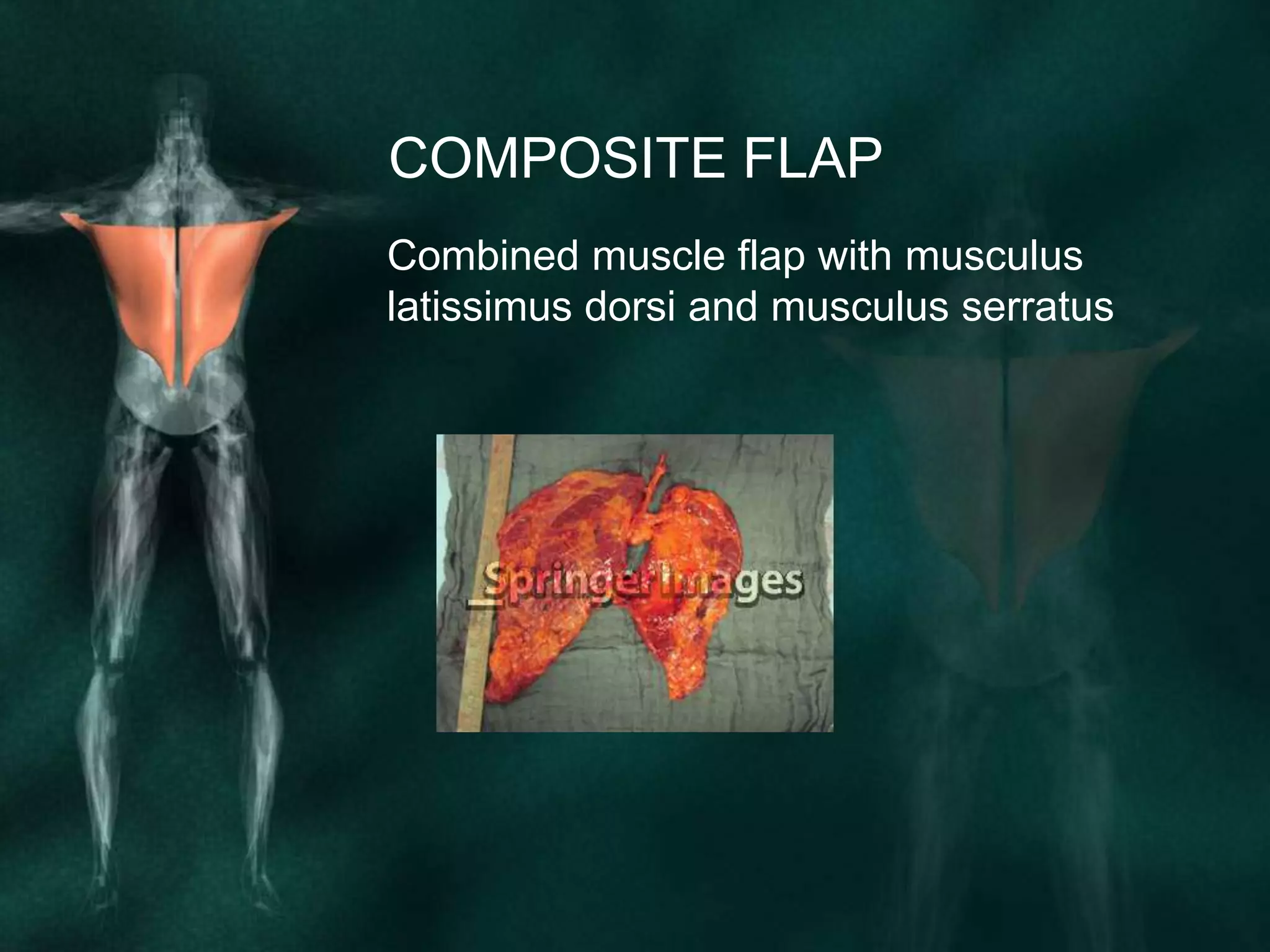 Latissimus dorsi flap for reconstruction in head and neck deffects | PPTX