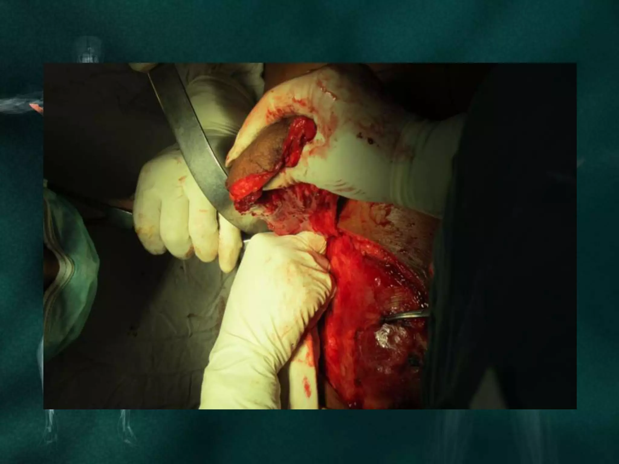 Latissimus Dorsi Flap For Reconstruction In Head And Neck Deffects Ppt