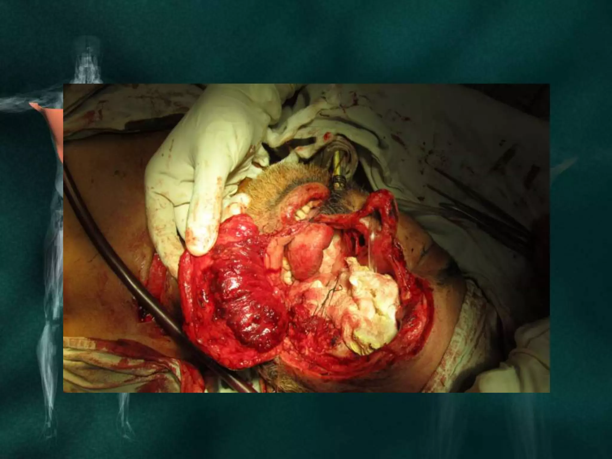 Latissimus Dorsi Flap For Reconstruction In Head And Neck Deffects Ppt
