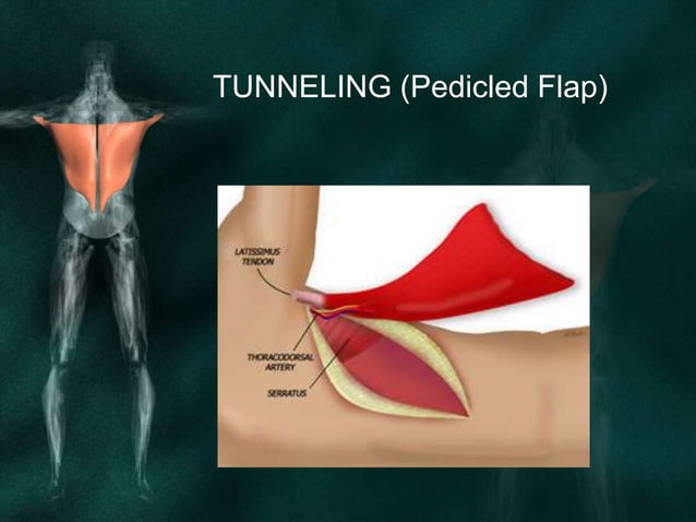 Latissimus Dorsi Flap For Reconstruction In Head And Neck Deffects