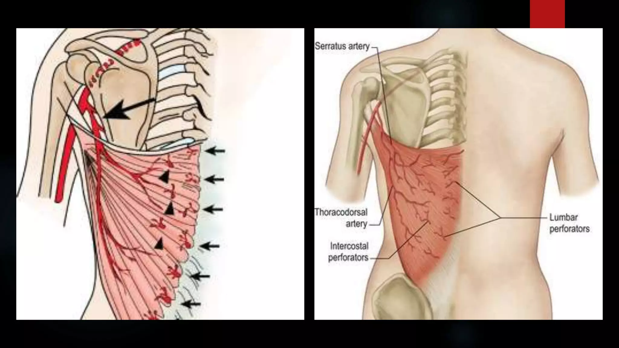 Latissimus dorsi flap | PPTX