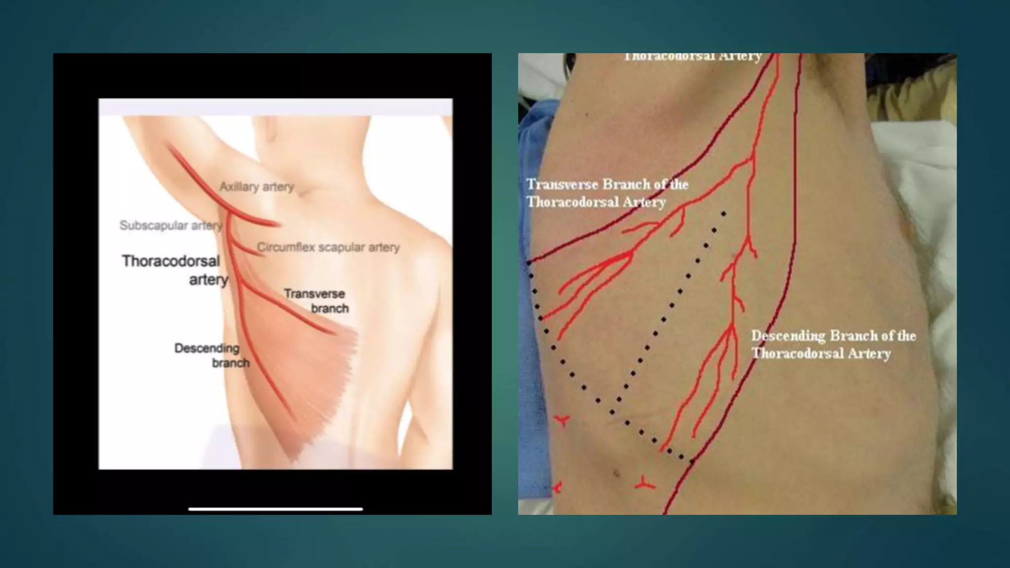 Latissimus Dorsi Flap Ppt