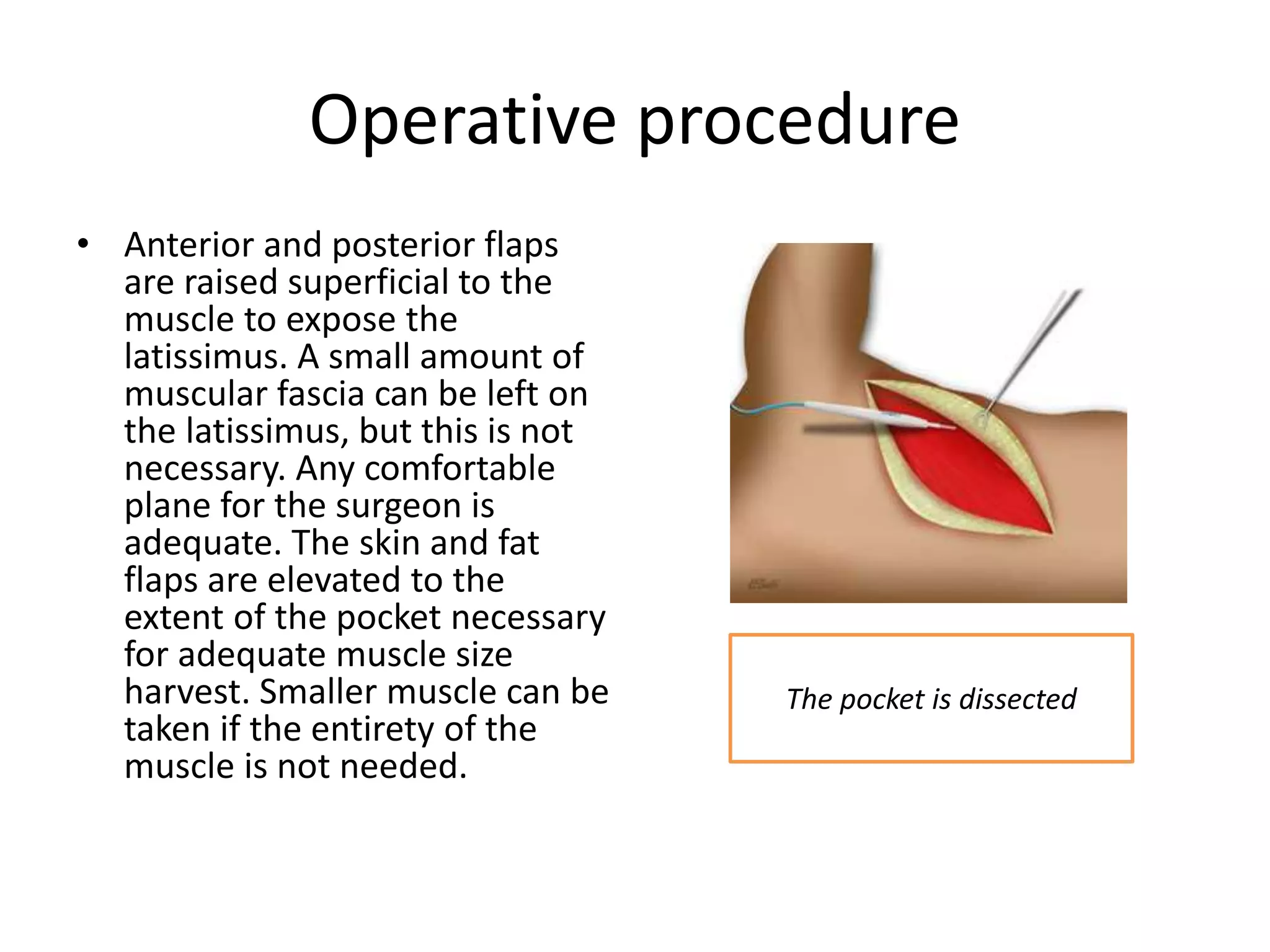 Latissimus dorsi free flap | PPT