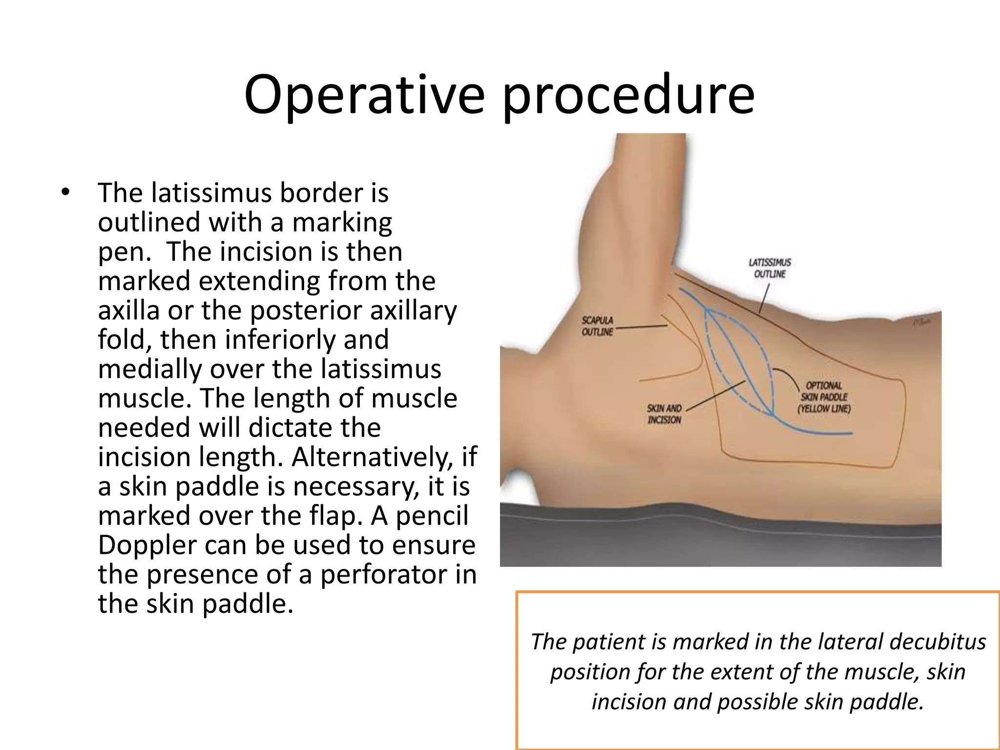 Latissimus dorsi free flap | PPT