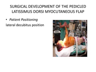 Latissimus dorsi myocutaneous pedicled flap | PPT