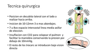 La toracoscopia hoy | PPTX