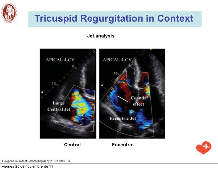 Tricuspid Regurgitation in Context