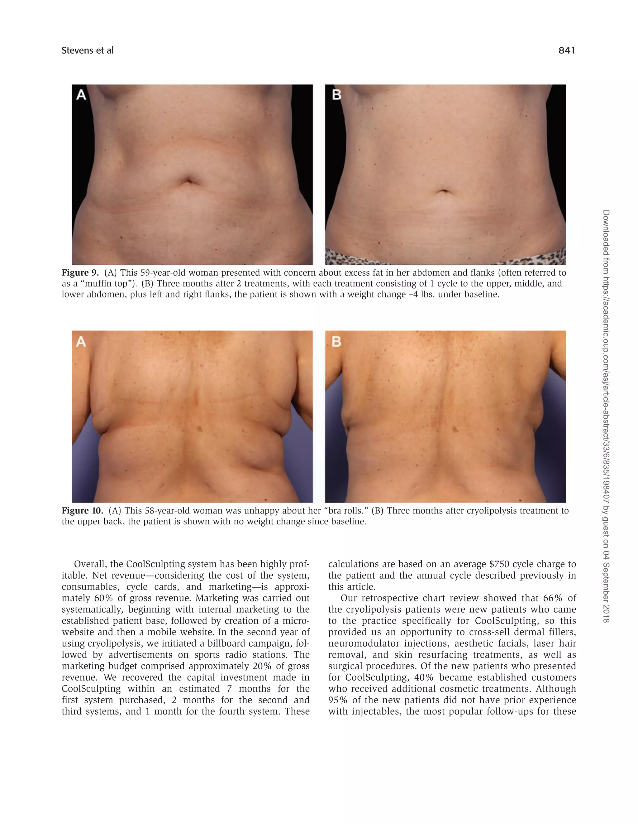 Laura Dyer CoolSculpting Study.pdf