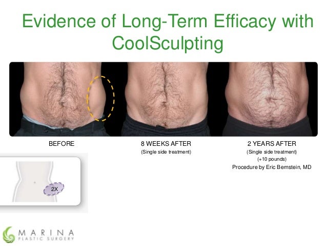 Laura Pietrzak CoolSculpting Treatment Technique - New York