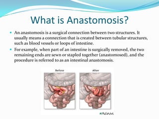 Lavage, Hernioplasty, Extraction, And Anastomosis | PPTX