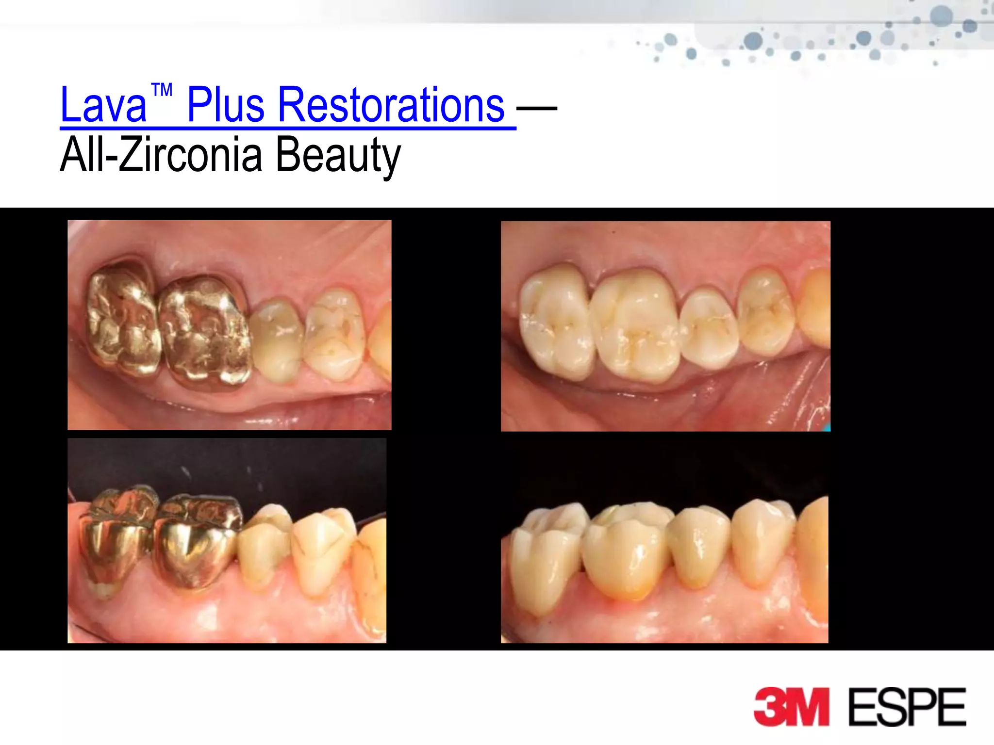 Lava Plus High Translucency Zirconia | PPTX