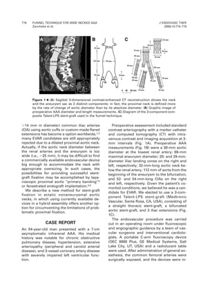 FUNNEL TECHNIQUE, J ENDOVASC THER 2006;13:775–778- Case Report-Funnel ...