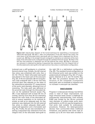 FUNNEL TECHNIQUE, J ENDOVASC THER 2006;13:775–778- Case Report-Funnel ...