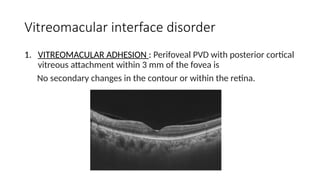 Layers of retina over OCT and histology.pptx