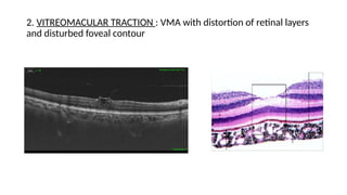 Layers of retina over OCT and histology.pptx