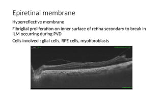 Layers of retina over OCT and histology.pptx