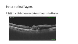 Layers of retina over OCT and histology.pptx