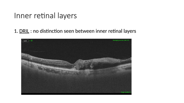 Layers of retina over OCT and histology.pptx