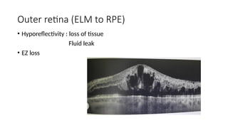 Layers of retina over OCT and histology.pptx