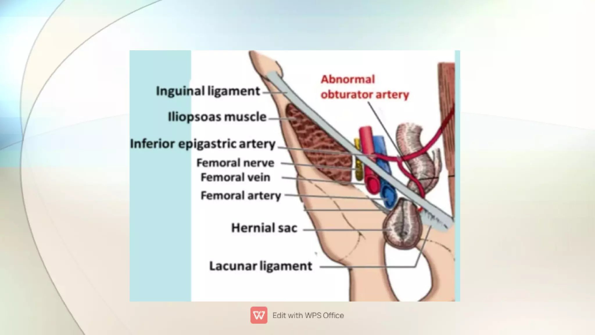FEMORAL_SHEATH_AND_FEMORAL_HERNIA(2).pdf