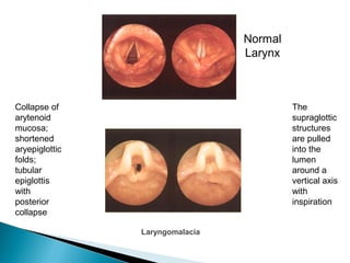 Layrngeal pathologiess | PPT