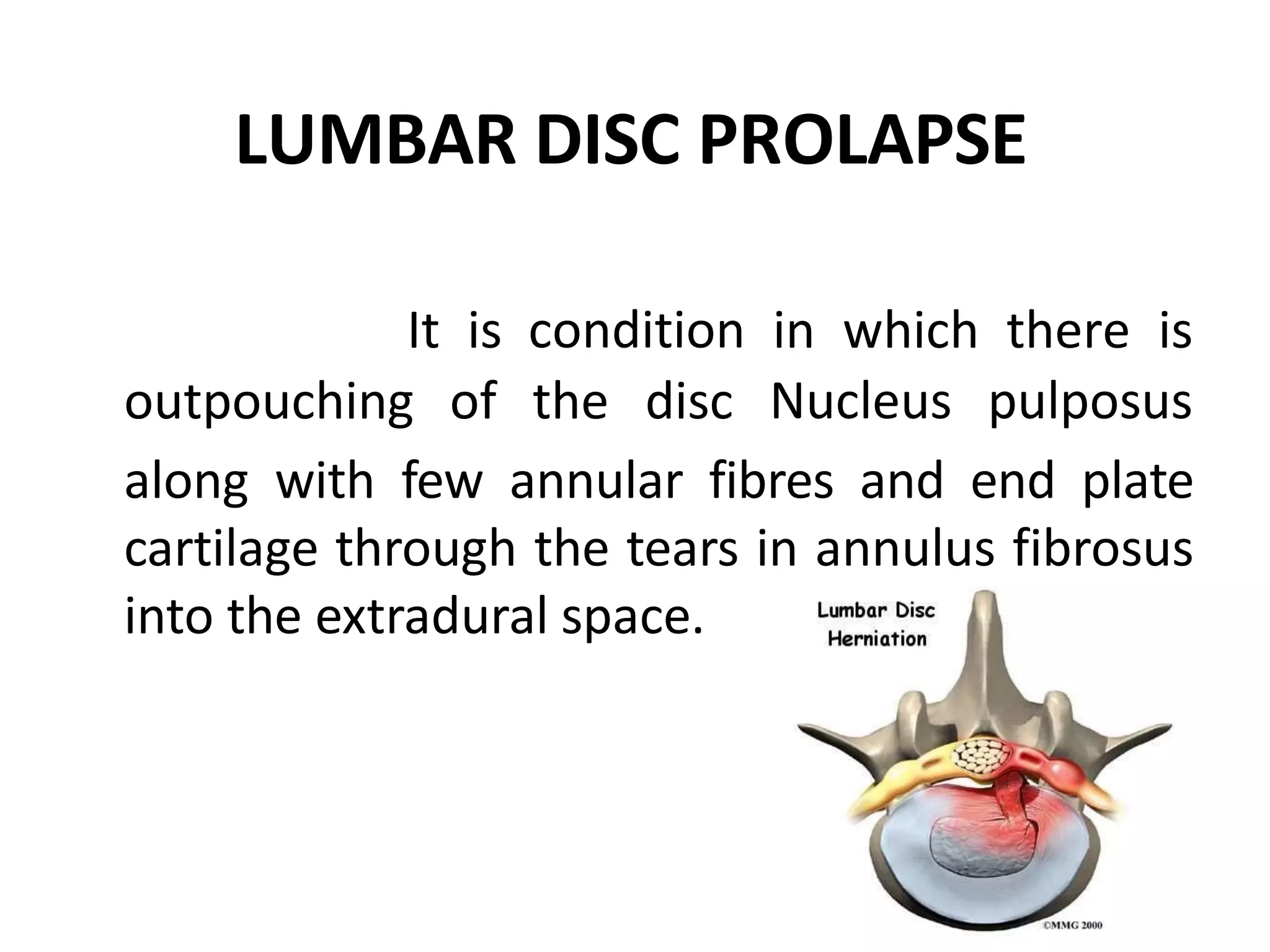 Prolapsed intervertebral disc | PPTX
