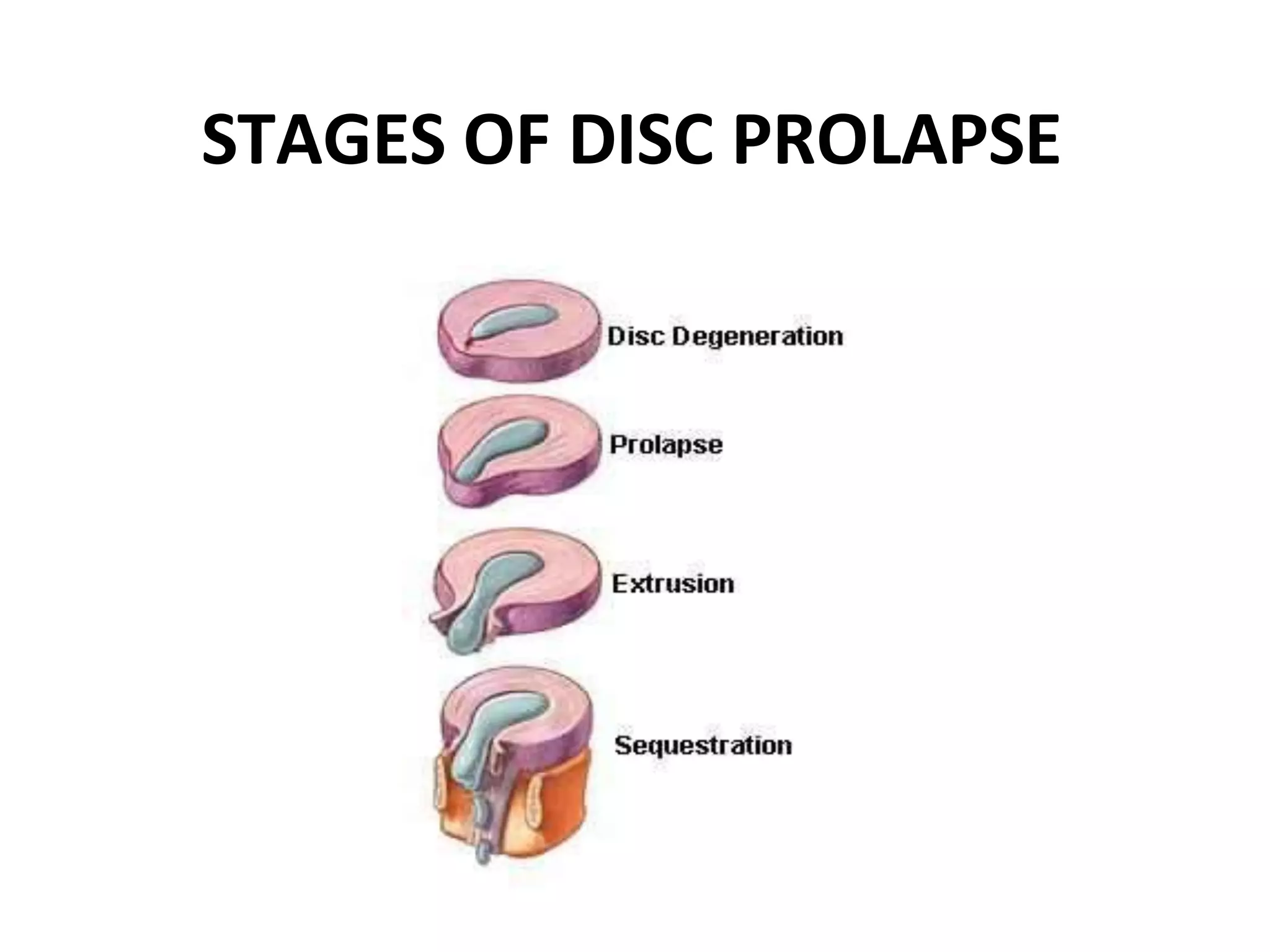 Prolapsed intervertebral disc | PPTX