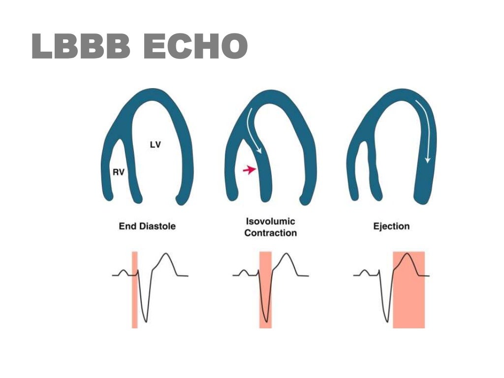 LBBB