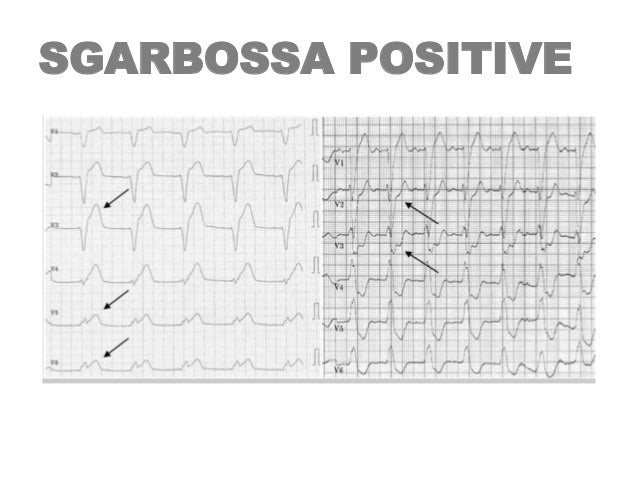 LBBB