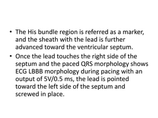 Lbbb pacing | PPTX