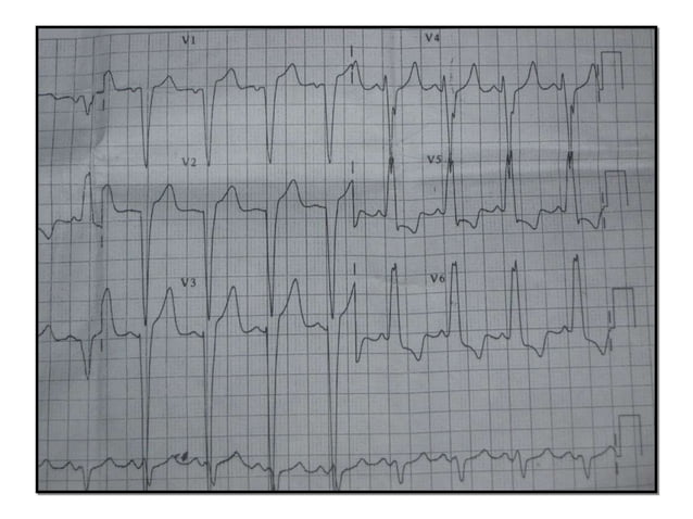 ECG: LBBB and Acute MI | PPT