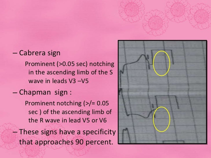 ECG: LBBB and Acute MI