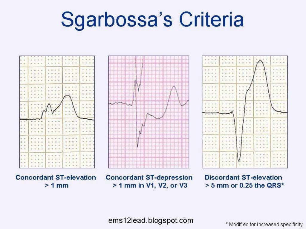 ECG: LBBB and Acute MI