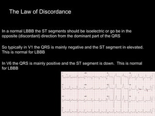 Lbbb + sgarbossa | PPTX