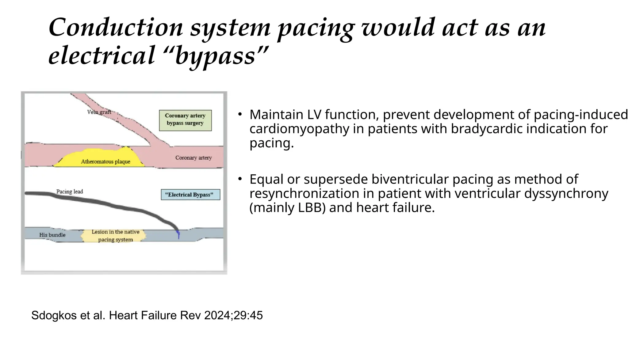 Conduction system pacing (with emphasis on left bundle branch pacing ...