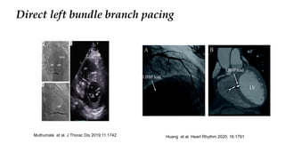 Conduction system pacing (with emphasis on left bundle branch pacing ...