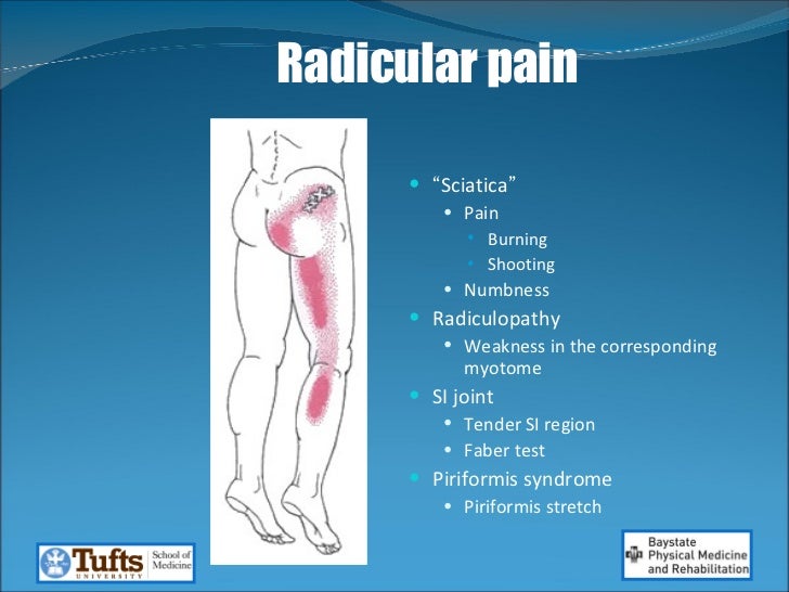Radiculitis Radicular Pain Causes Symptoms Treatment