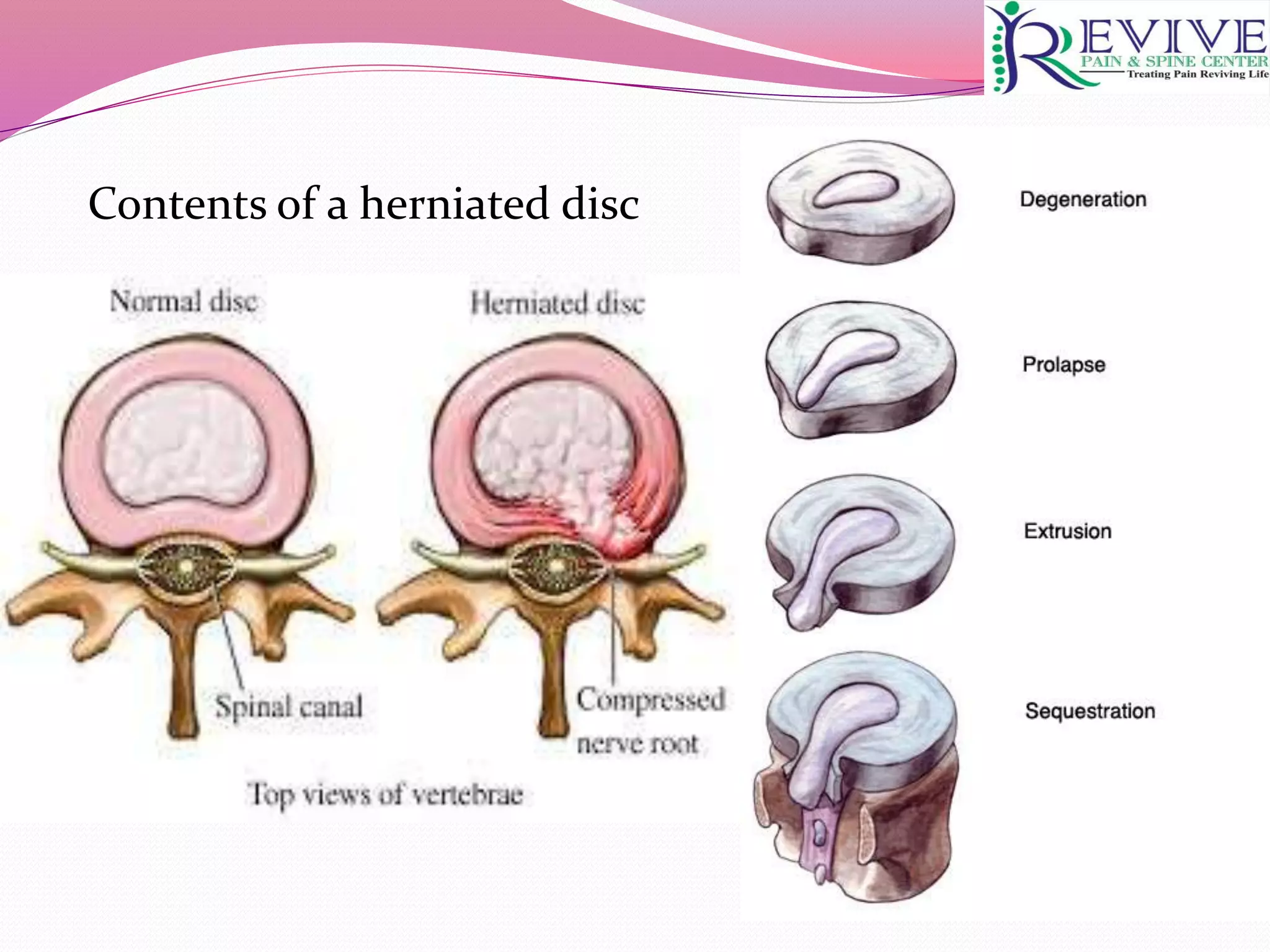 Lbp differentials | PPTX