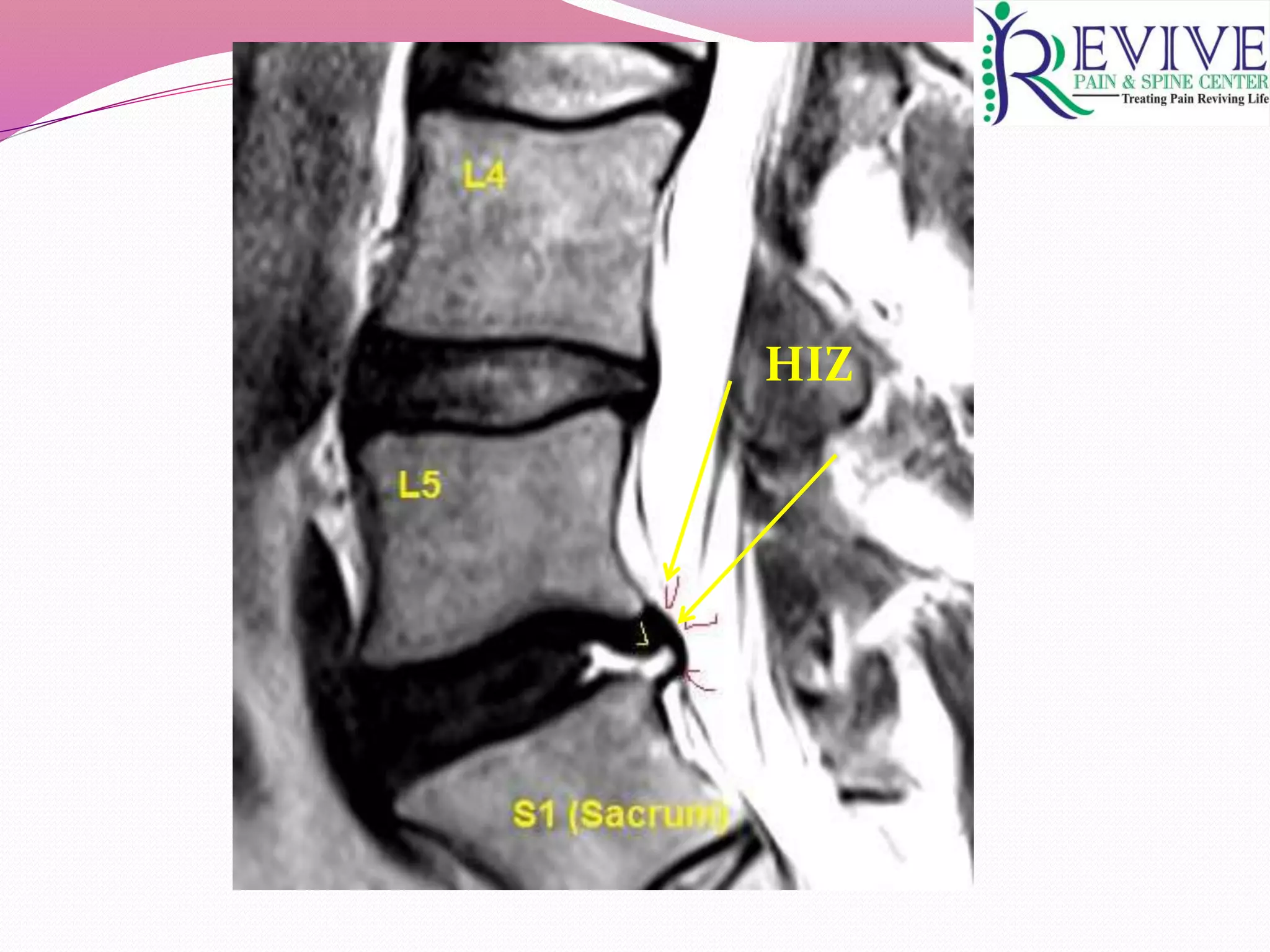 Lbp differentials | PPTX