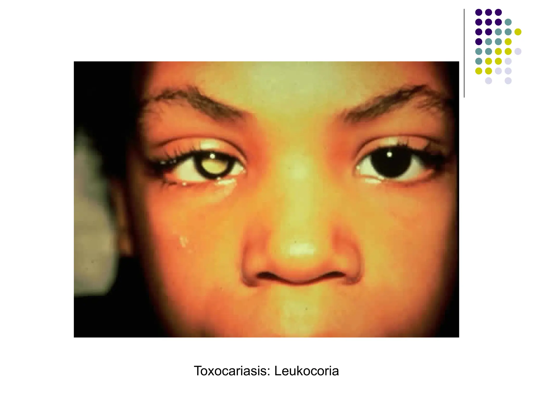 Uveitis ophthalmology anterior, posterior and pan | PPTX | Eye and ...