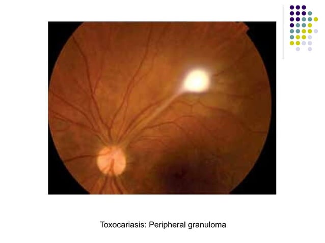 Uveitis ophthalmology anterior, posterior and pan | PPTX | Eye and ...