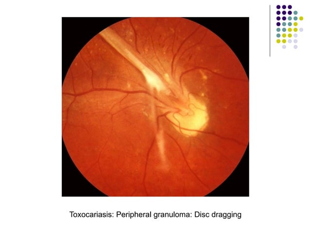 Uveitis ophthalmology anterior, posterior and pan | PPTX | Eye and ...