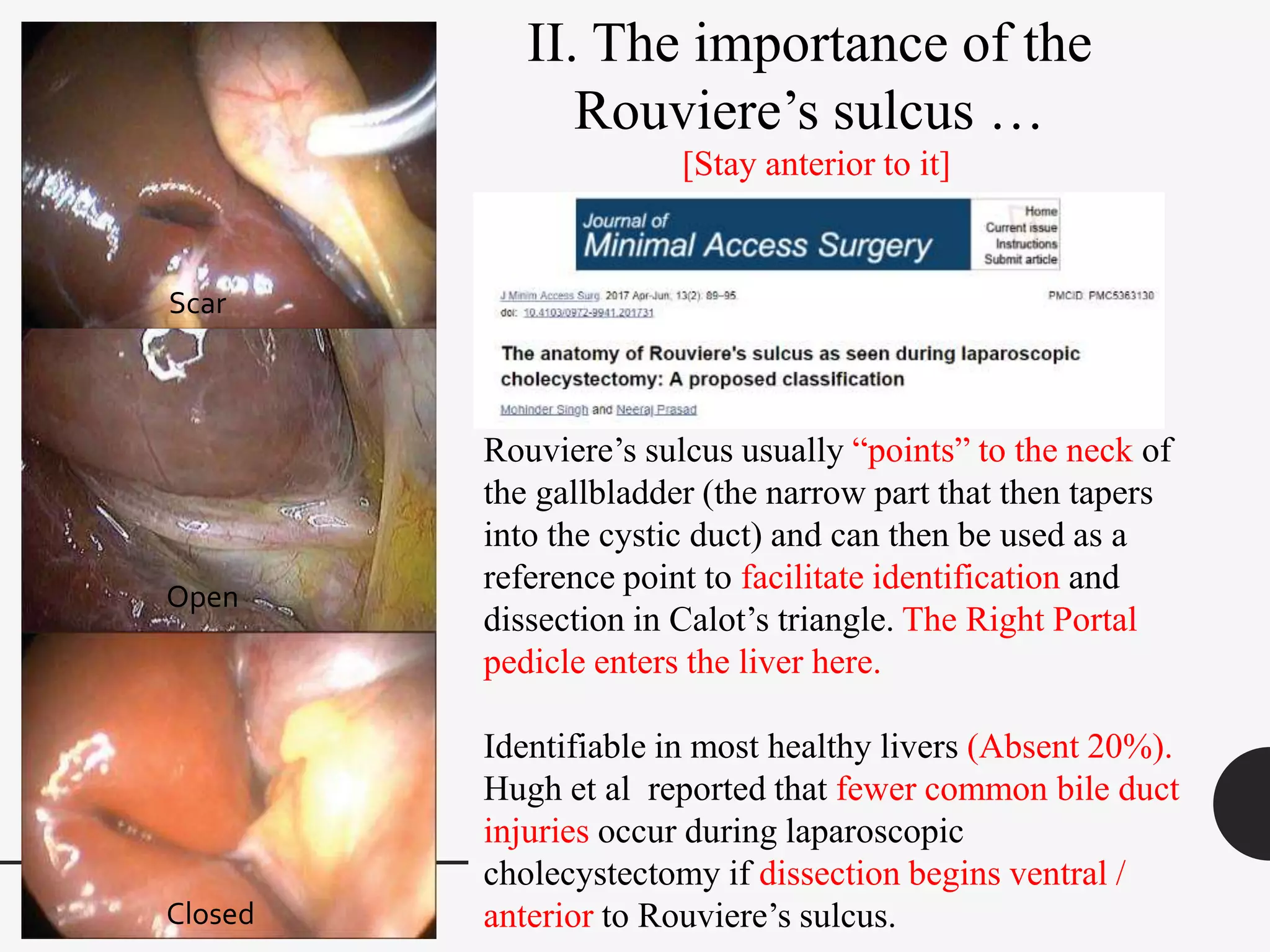 Laparoscopic Cholecystectomy | PPTX